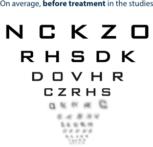 Treatment for Wet Age-related Macular Degeneration (Wet AMD)