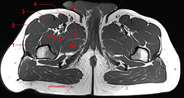 MRI of the Thigh: Detailed Anatomy (Superior Part) - W-Radiology