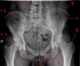Pelvis Radiograph - W-Radiology