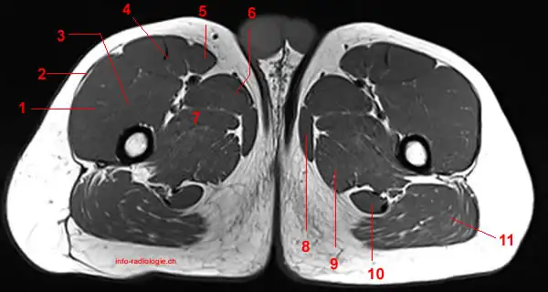 MRI of the Thigh: Detailed Anatomy (Superior Part) - W-Radiology
