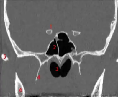Paranasal sinuses CT anatomy - W-Radiology