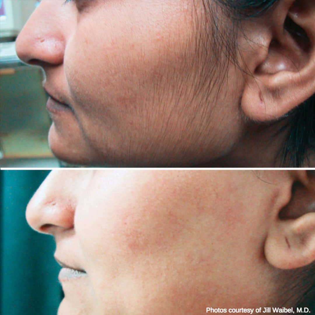 BEFORE & AFTER Laser Treatment - Canada MedLaser Clinics