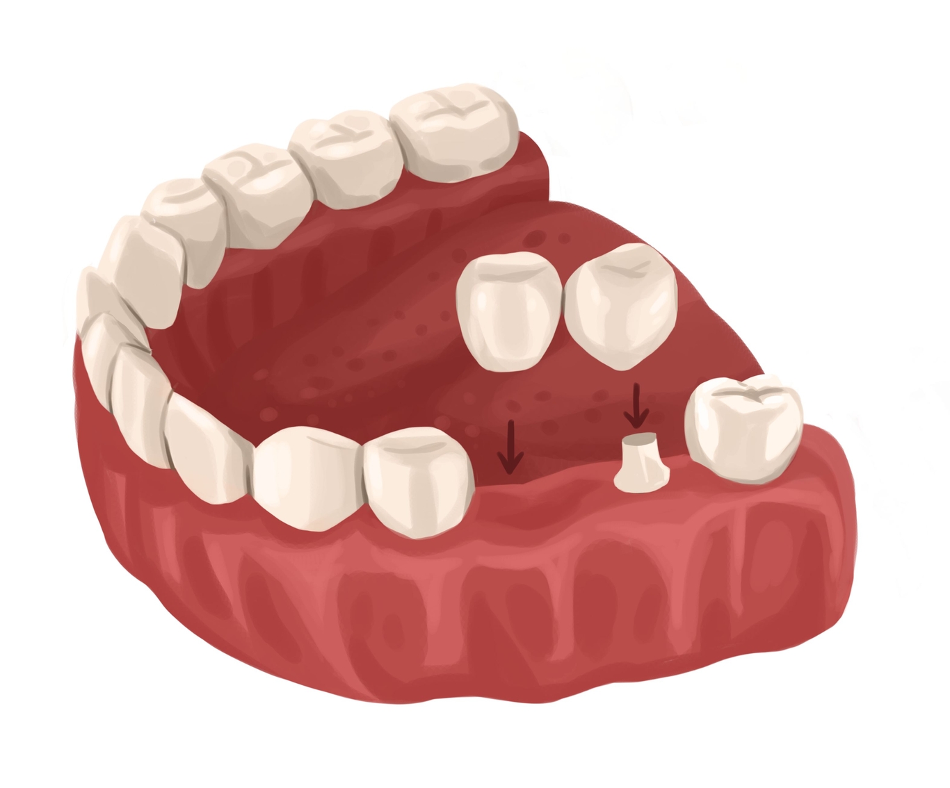 Dental bridge: types, and procedure | Authority Dental