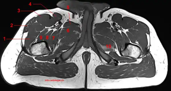 MRI of the Thigh: Detailed Anatomy (Superior Part) - W-Radiology