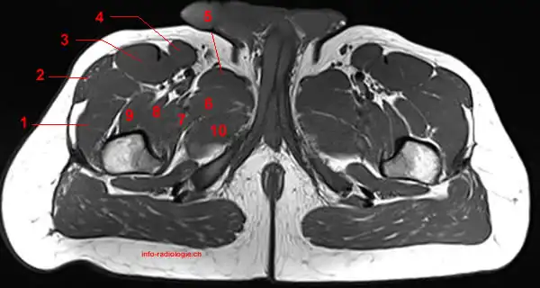 MRI of the Thigh: Detailed Anatomy (Superior Part) - W-Radiology