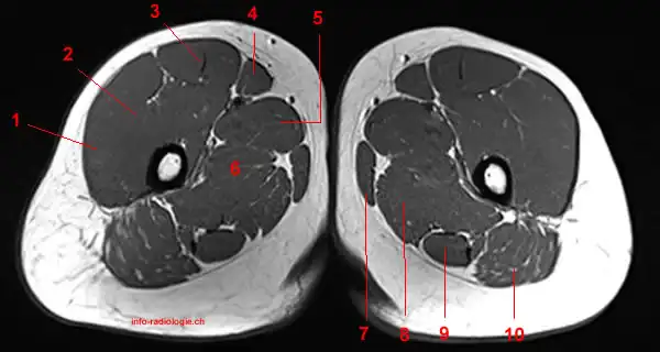 MRI of the Thigh: Detailed Anatomy (Superior Part) - W-Radiology