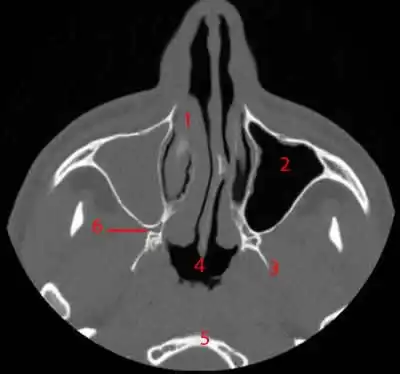 Paranasal sinuses CT anatomy - W-Radiology