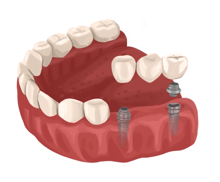 Dental bridge: types, and procedure | Authority Dental