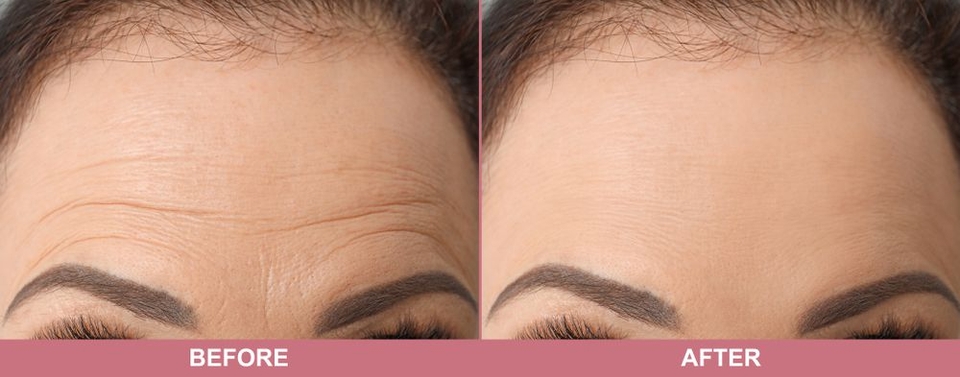 Top Treatment Options For Forehead Wrinkles in Vaughan - Toronto Laser Clinics