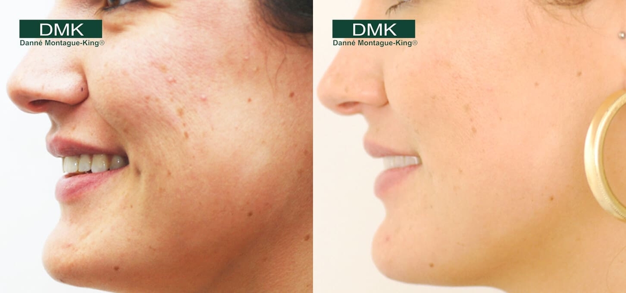 DMK Enzyme Therapy Ottawa - Effective Treatment For Acne, Aging ...