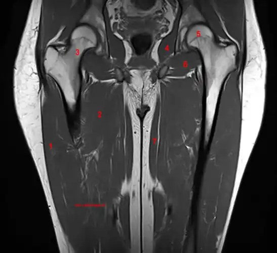 MRI of the Thigh: Detailed Anatomy (Superior Part) - W-Radiology