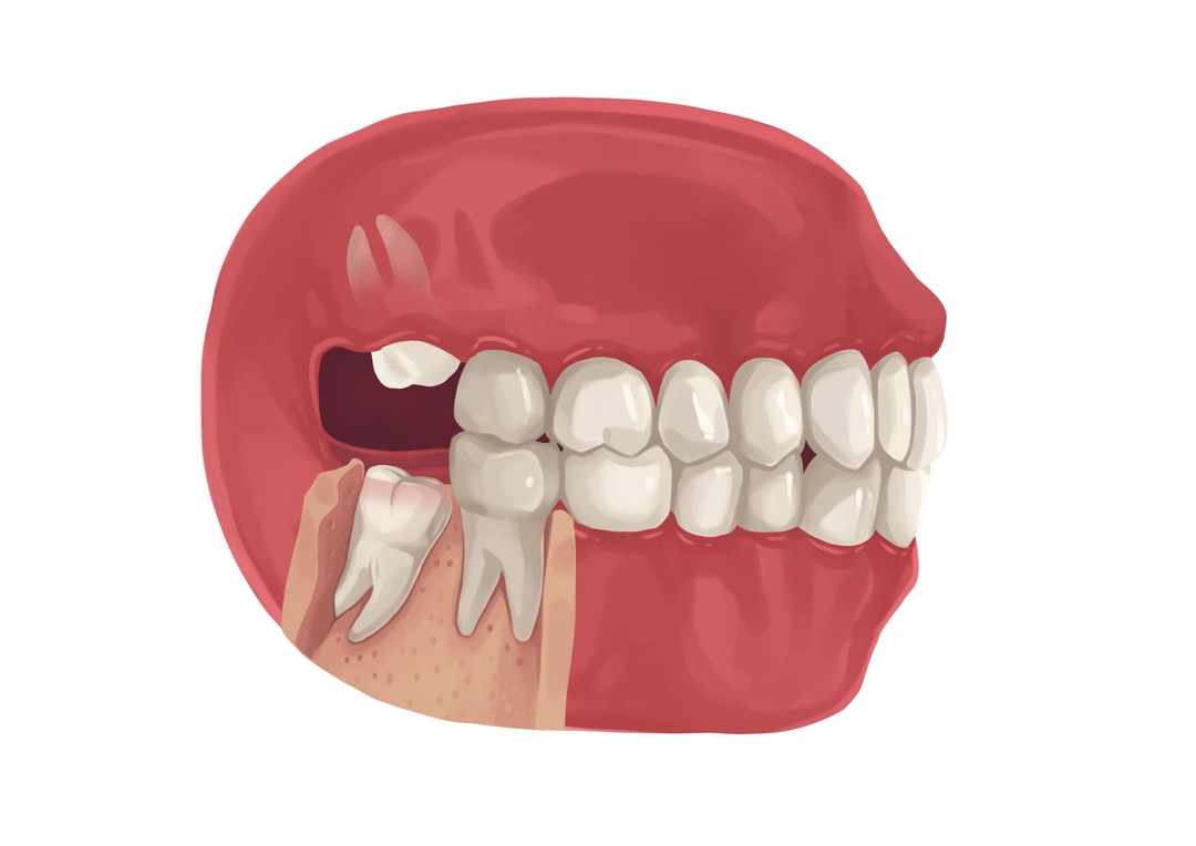 Wisdom tooth extraction costs from $200 up to $1,100 | Authority Dental