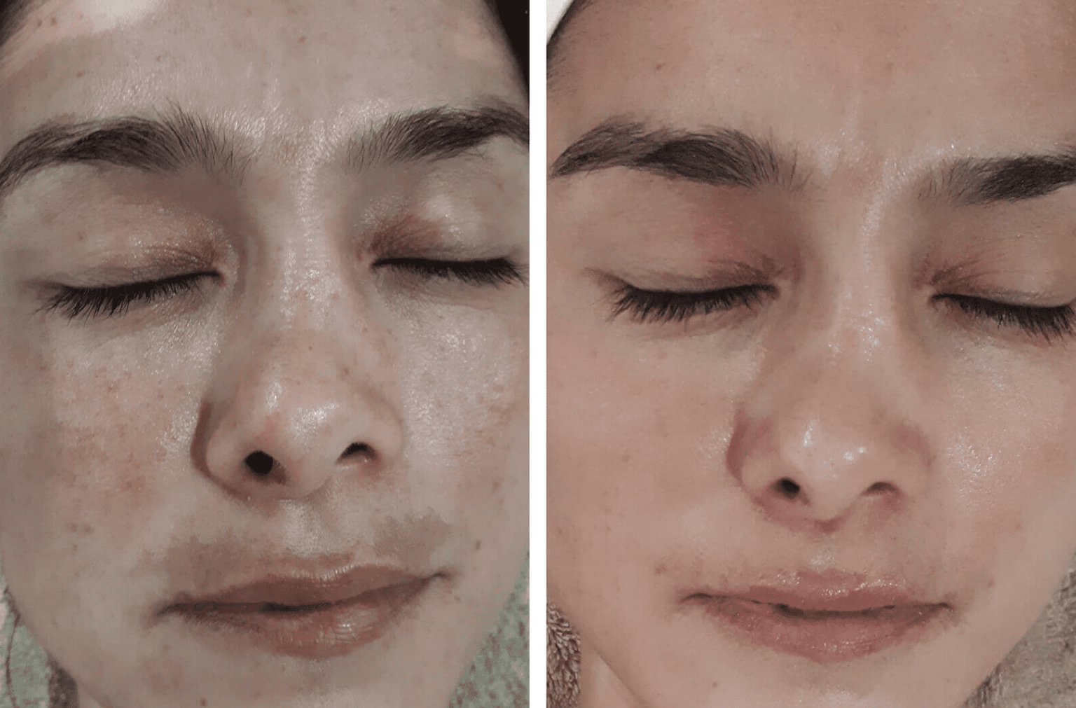 Hyperpigmentation & Melasma Ottawa - Natural Treatment of Blemishes