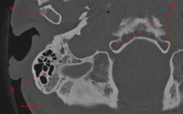 CT Scan of the Temporal Bone - W-Radiology