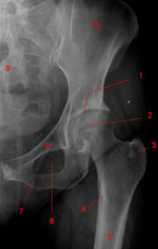 Hip Radiography - W-Radiology