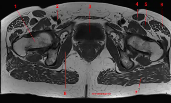 MRI of the Hip: Detailed Anatomy - W-Radiology