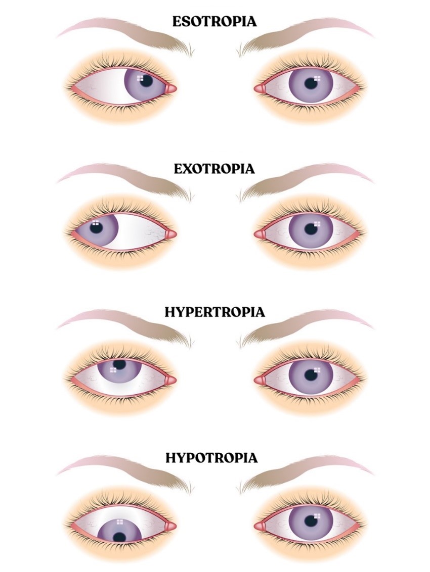 Amblyopia Innovative Eye Care Amblyopia Innovative Eye Care