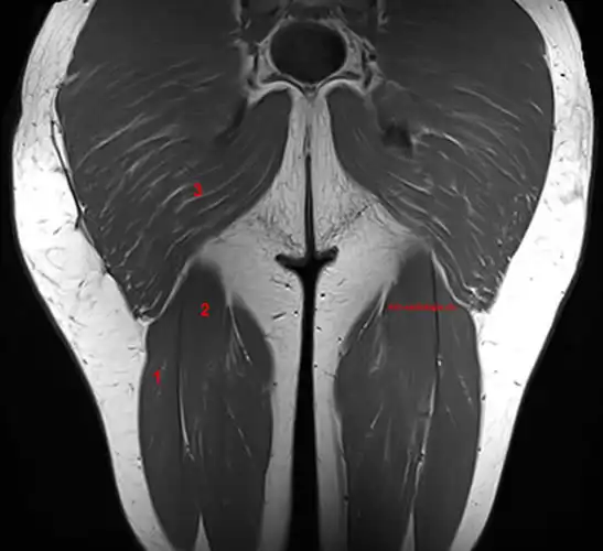 MRI of the Thigh: Detailed Anatomy (Superior Part) - W-Radiology