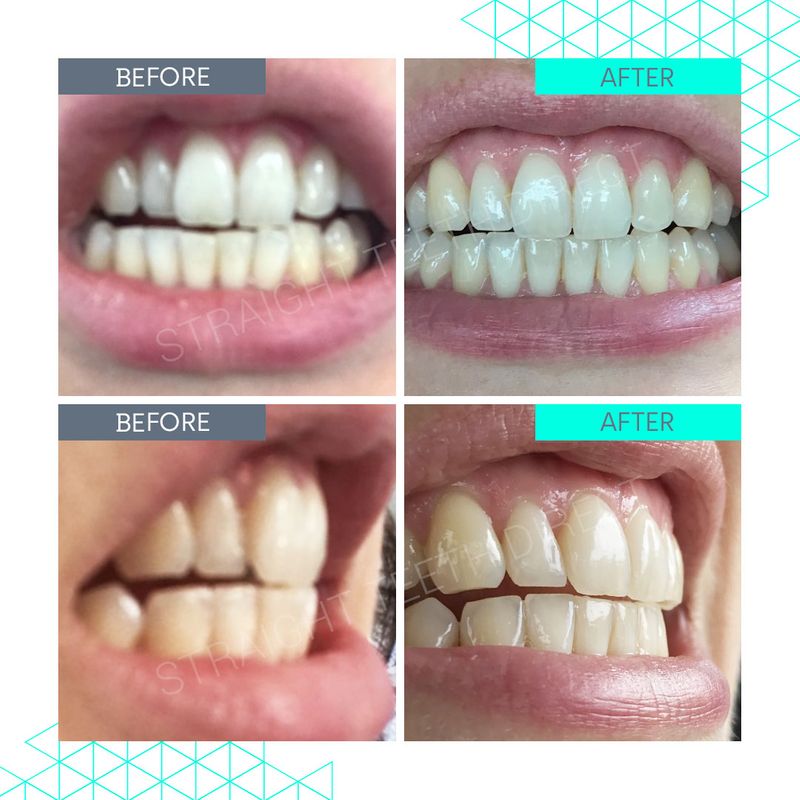 Premium Teeth Whitening - Straight Teeth Direct™