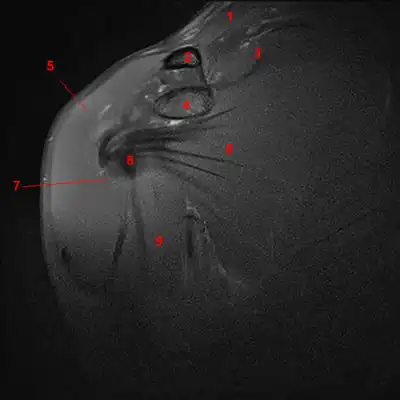 Atlas of Shoulder MRI Anatomy - W-Radiology