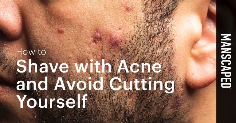 How to Shave With Acne and Avoid Cutting Yourself | MANSCAPED™ Blog