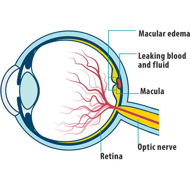 Understanding Wet Age-related Macular Degeneration (Wet AMD)