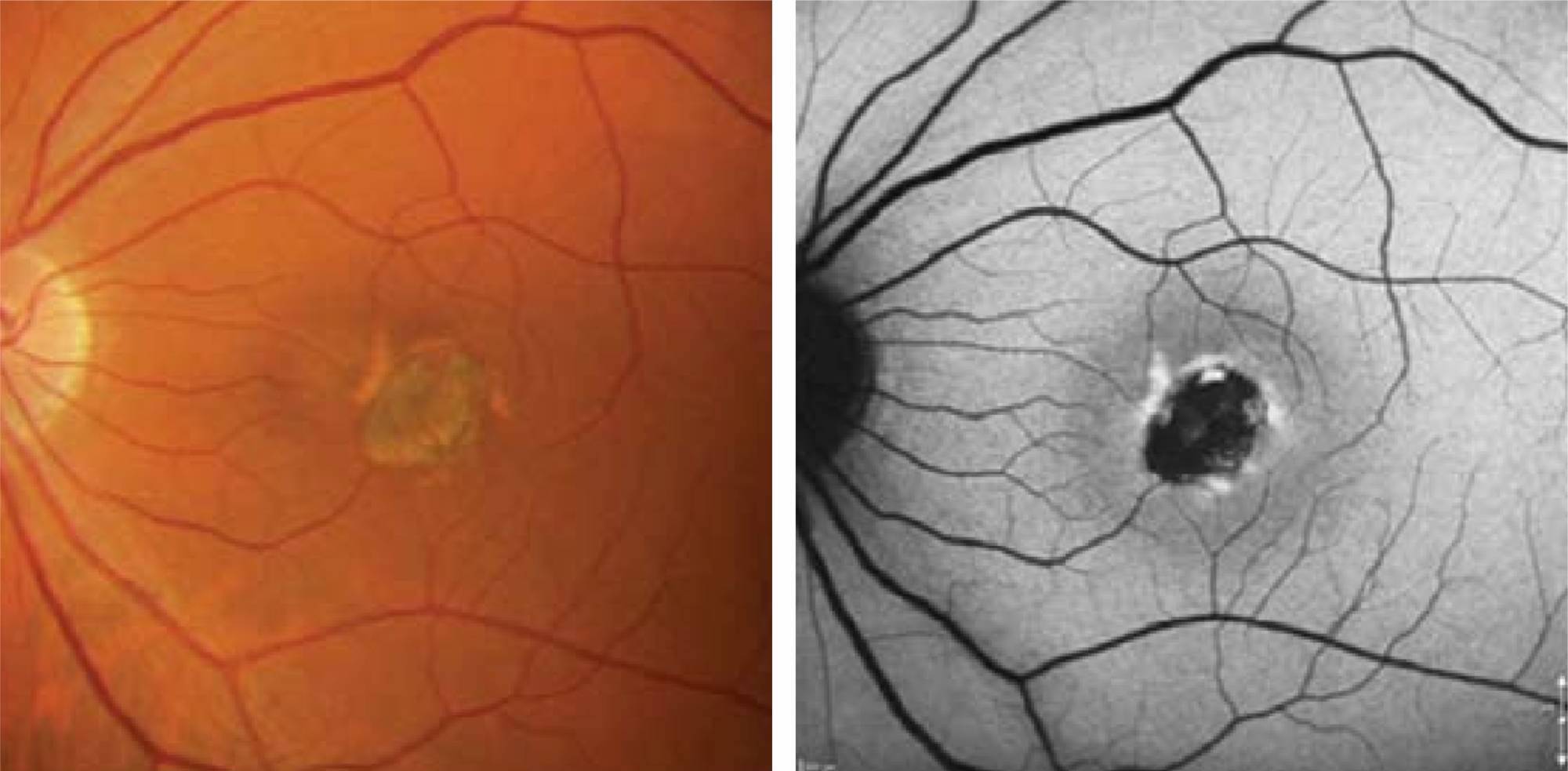 Fundus Autofluorescence - Innovative Eye Care