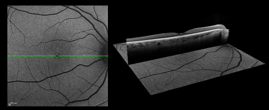 Fundus Autofluorescence - Innovative Eye Care