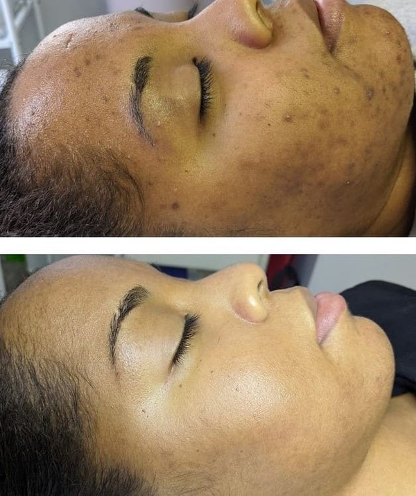 Hyperpigmentation & Melasma Ottawa - Natural Treatment of Blemishes