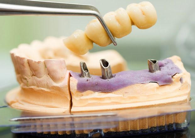 Prótese sobre implante dentário - Você sabe o que é ? | MD Odontologia