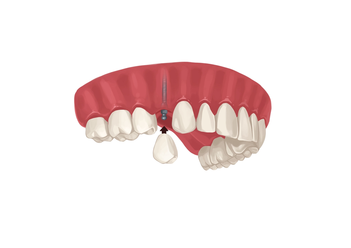 Dental implants