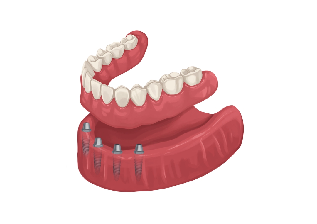 12 Easy ways to get affordable dental implants in 2022 | Authority Dental