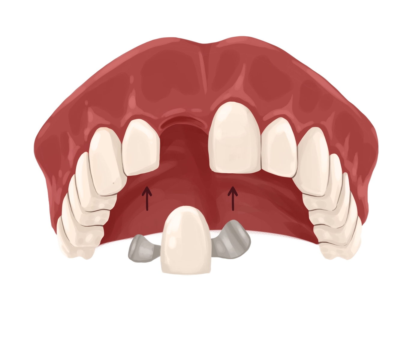 Dental Bridge Types And Procedure Authority Dental Dental Bridge Types And Procedure Authority Dental